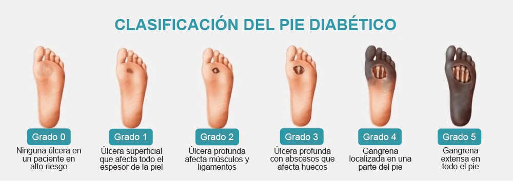 Tipos de úlceras en el pie diabético - Unidad del Pie Diabético en ...